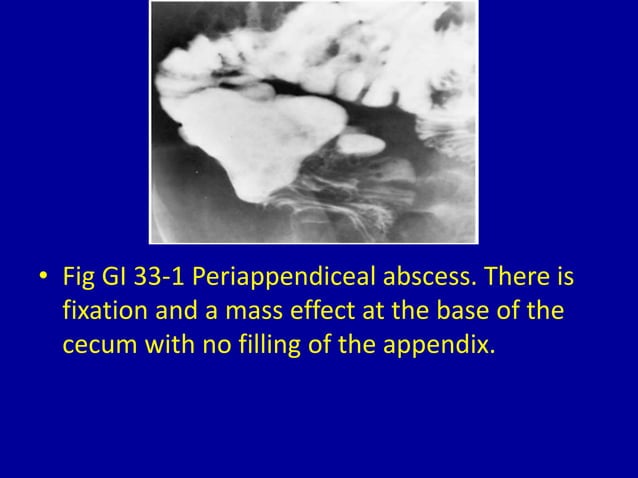 33 filling defects in the cecum | PPT