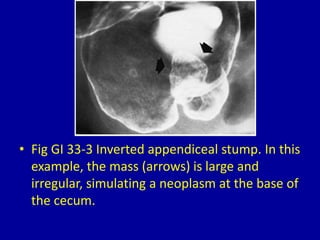 33 filling defects in the cecum | PPTX