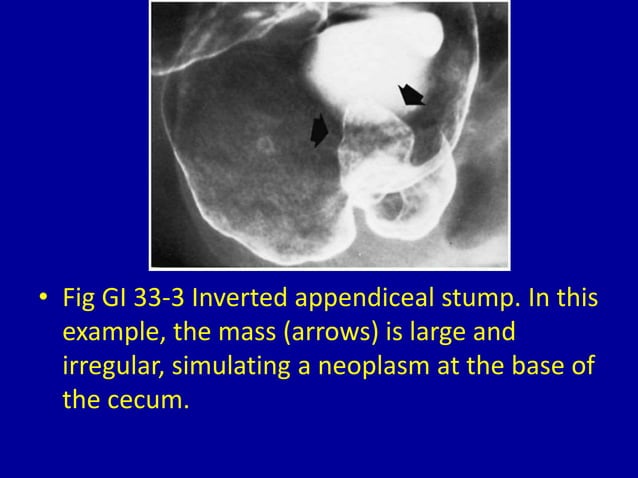 33 filling defects in the cecum | PPT
