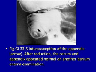 33 filling defects in the cecum | PPTX
