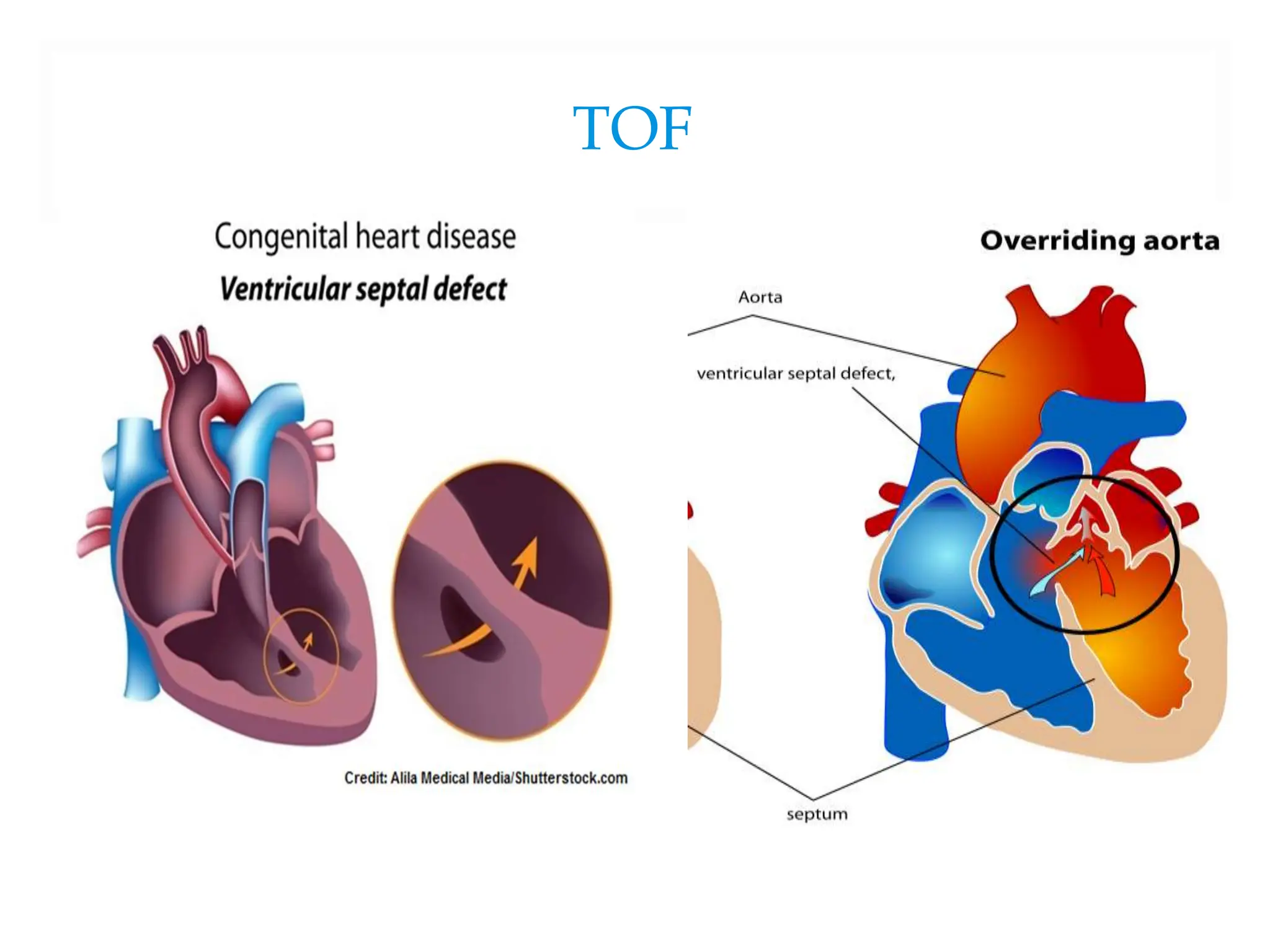 congenital Heart Defects.PDA,ASD,VSD,TGApptx | PPTX