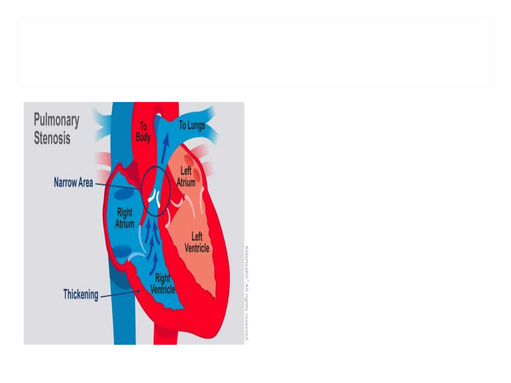 congenital Heart Defects.PDA,ASD,VSD,TGApptx | PPTX