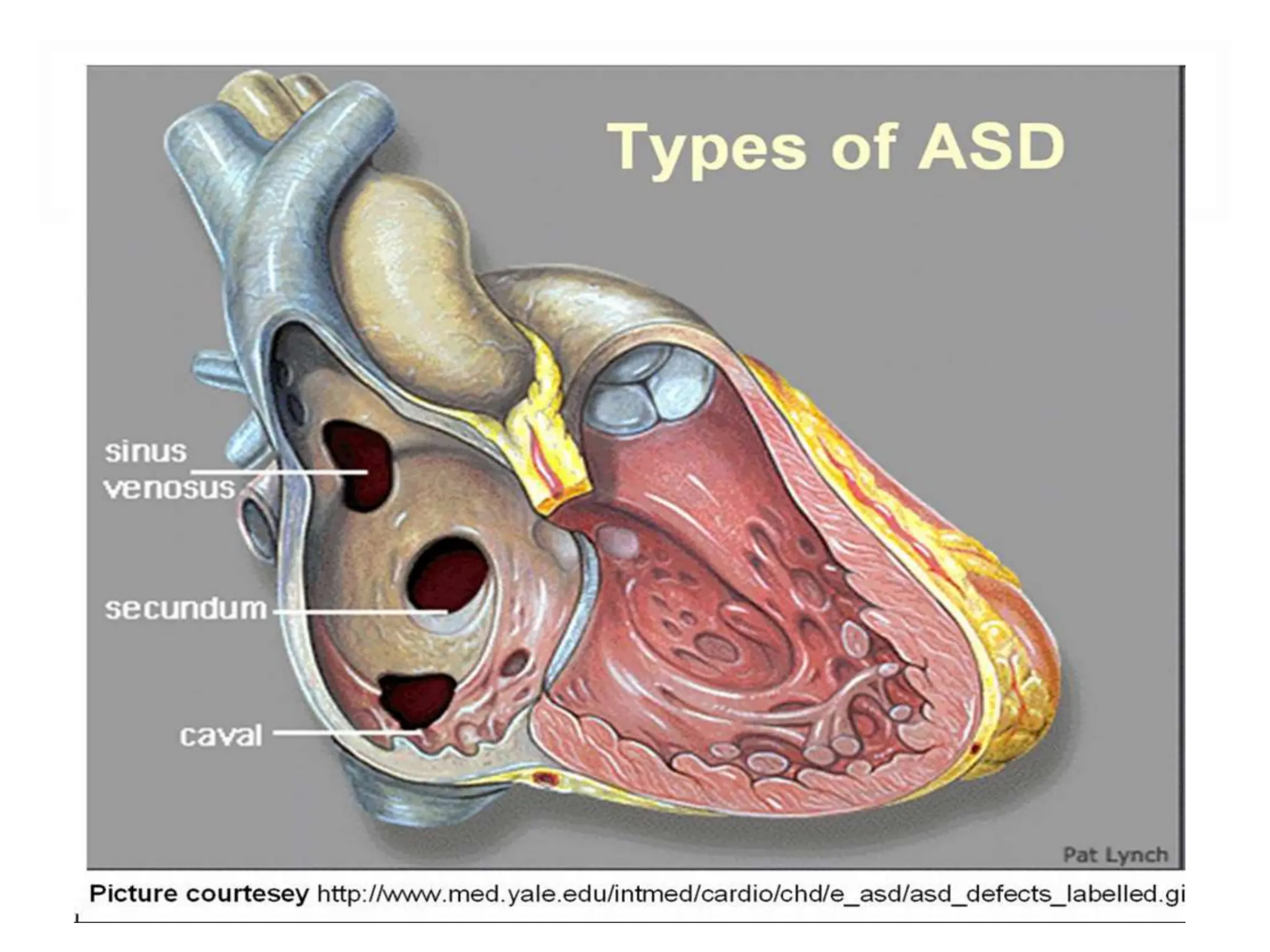 congenital Heart Defects.PDA,ASD,VSD,TGApptx | PPTX