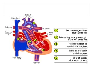 congenital Heart Defects.PDA,ASD,VSD,TGApptx | PPTX