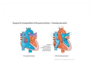 congenital Heart Defects.PDA,ASD,VSD,TGApptx | PPTX
