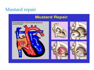 congenital Heart Defects.PDA,ASD,VSD,TGApptx | PPTX