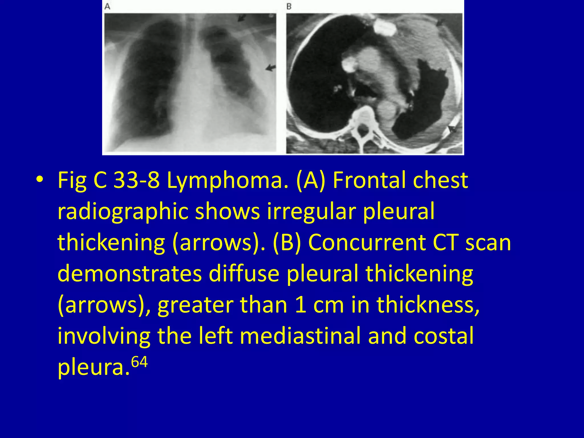33 pleural based lesion | PPTX