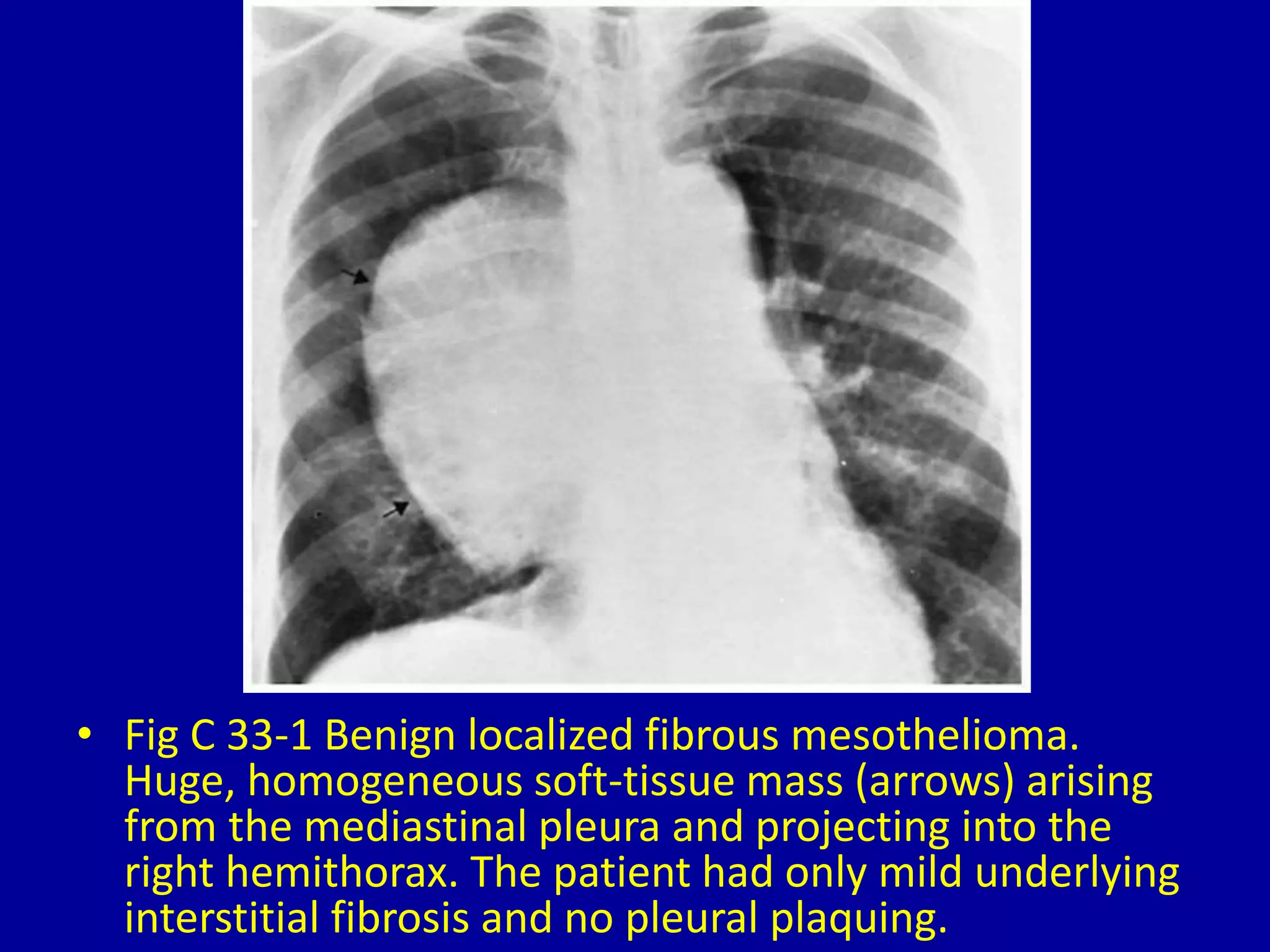 33 pleural based lesion | PPTX