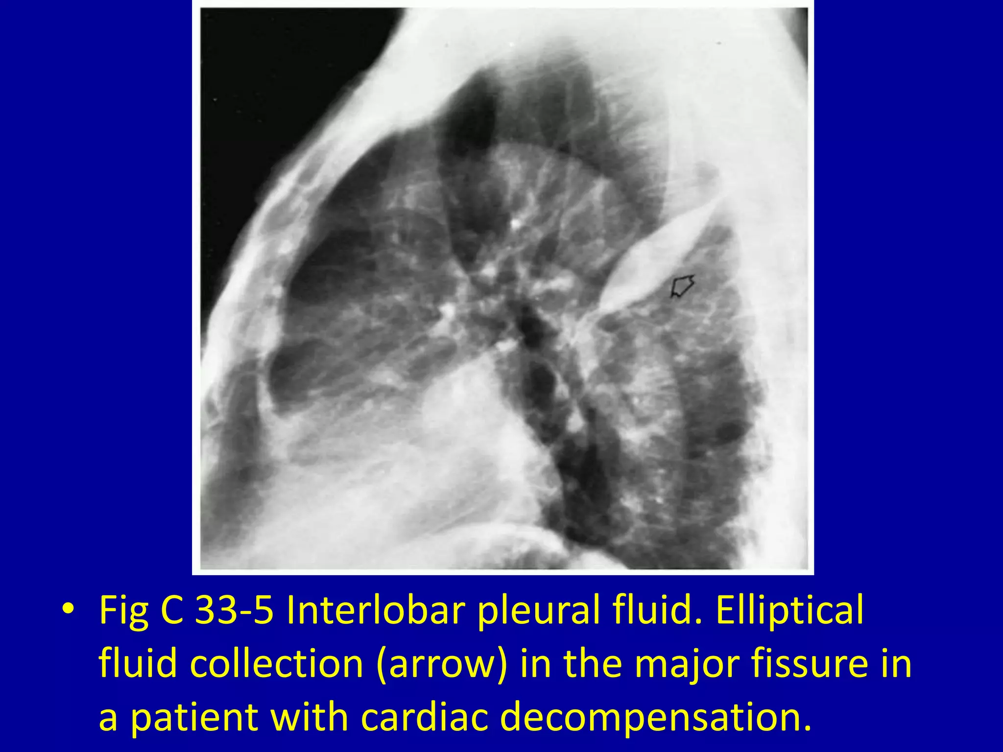 33 pleural based lesion | PPTX