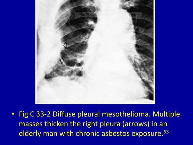 33 pleural based lesion | PPTX | Medical Health