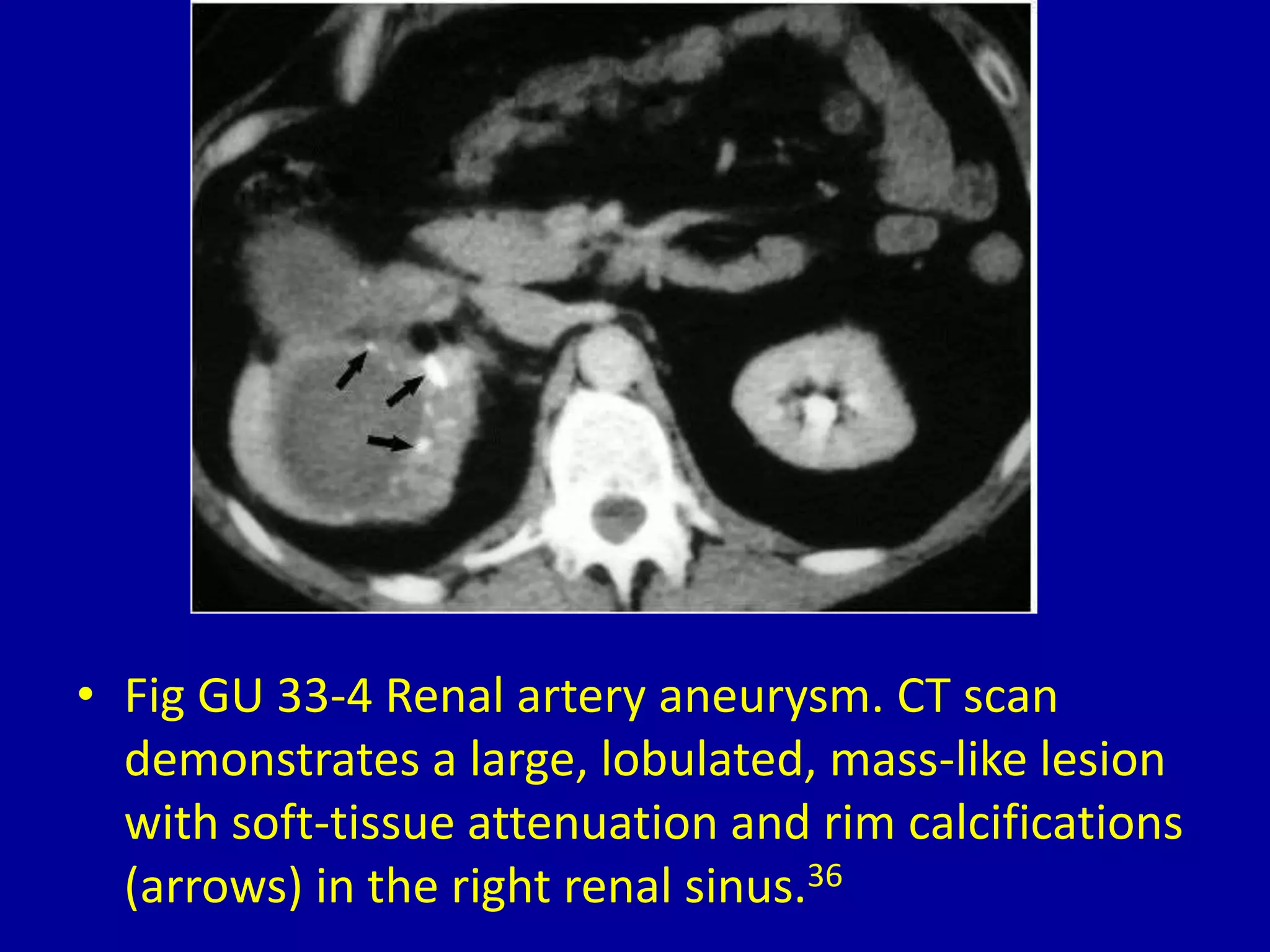 33 renal sinus abnormalities | PPTX | Medical Tests | Medical Health