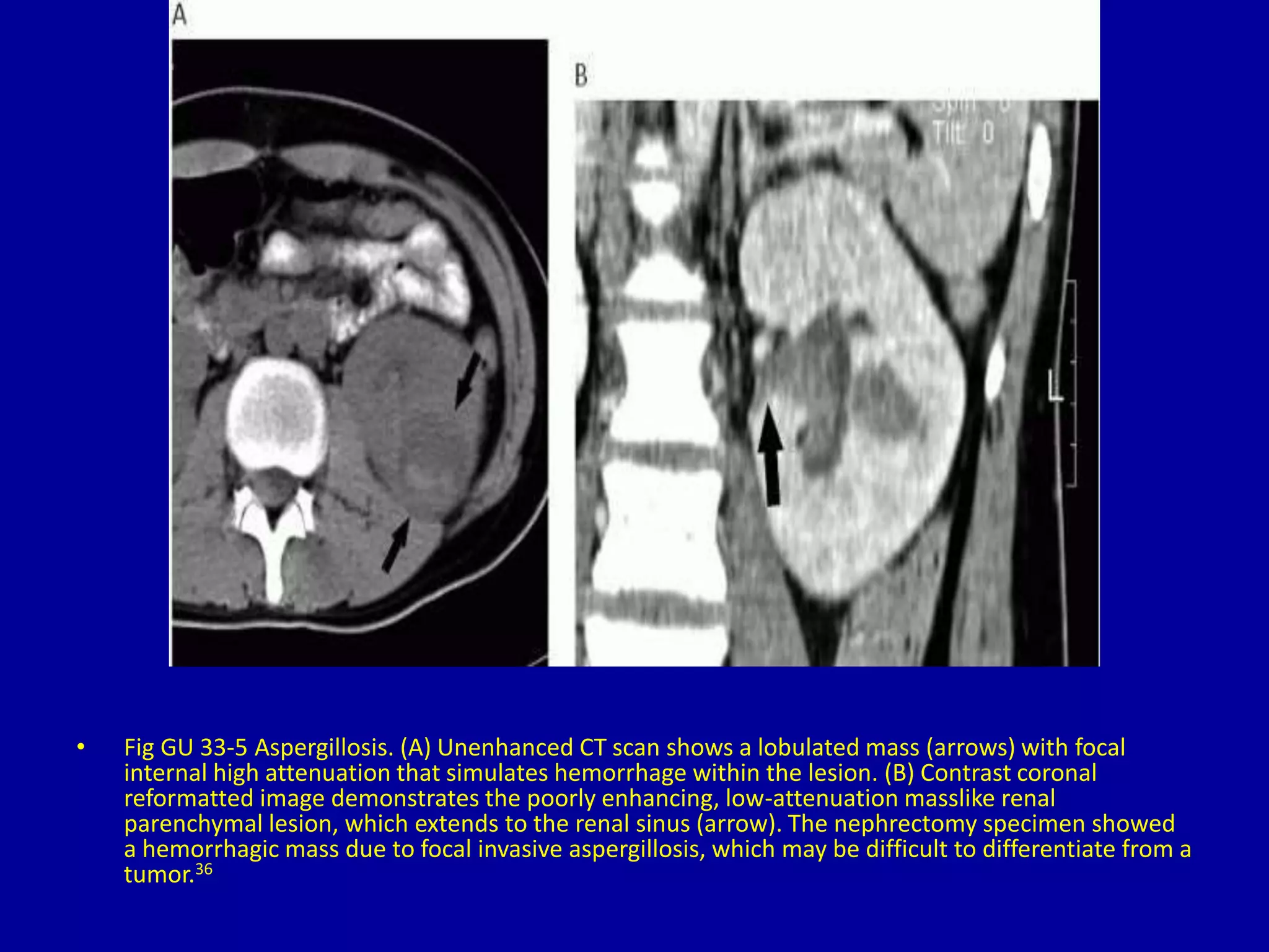 33 renal sinus abnormalities | PPTX | Medical Tests | Medical Health