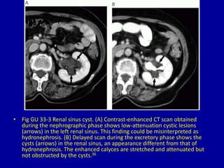 33 renal sinus abnormalities | PPTX | Medical Tests | Medical Health
