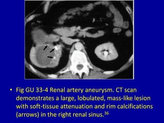 Renal Sinus