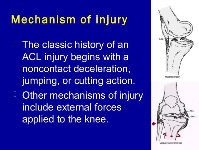 34. acl injuries