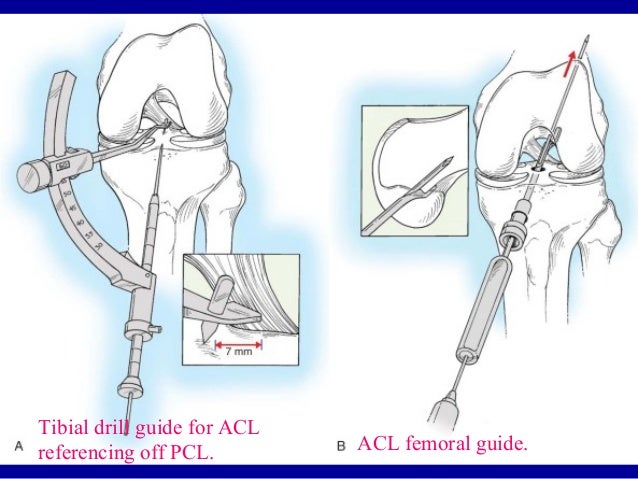 34. acl injuries