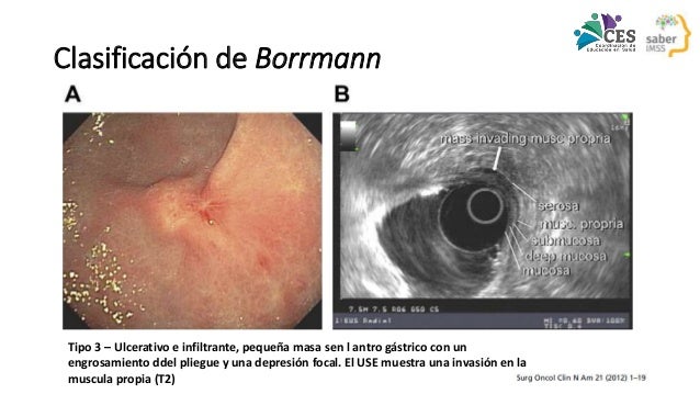 Cancer gastrico y Endoscopia