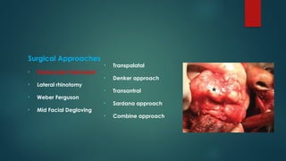 Comprehensive Overview of Nasopharyngeal Tumors: Angiofibroma and ...