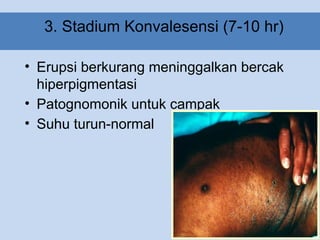 CAMPAk measles morbili patogenesis .pptx