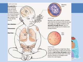 CAMPAk measles morbili patogenesis .pptx