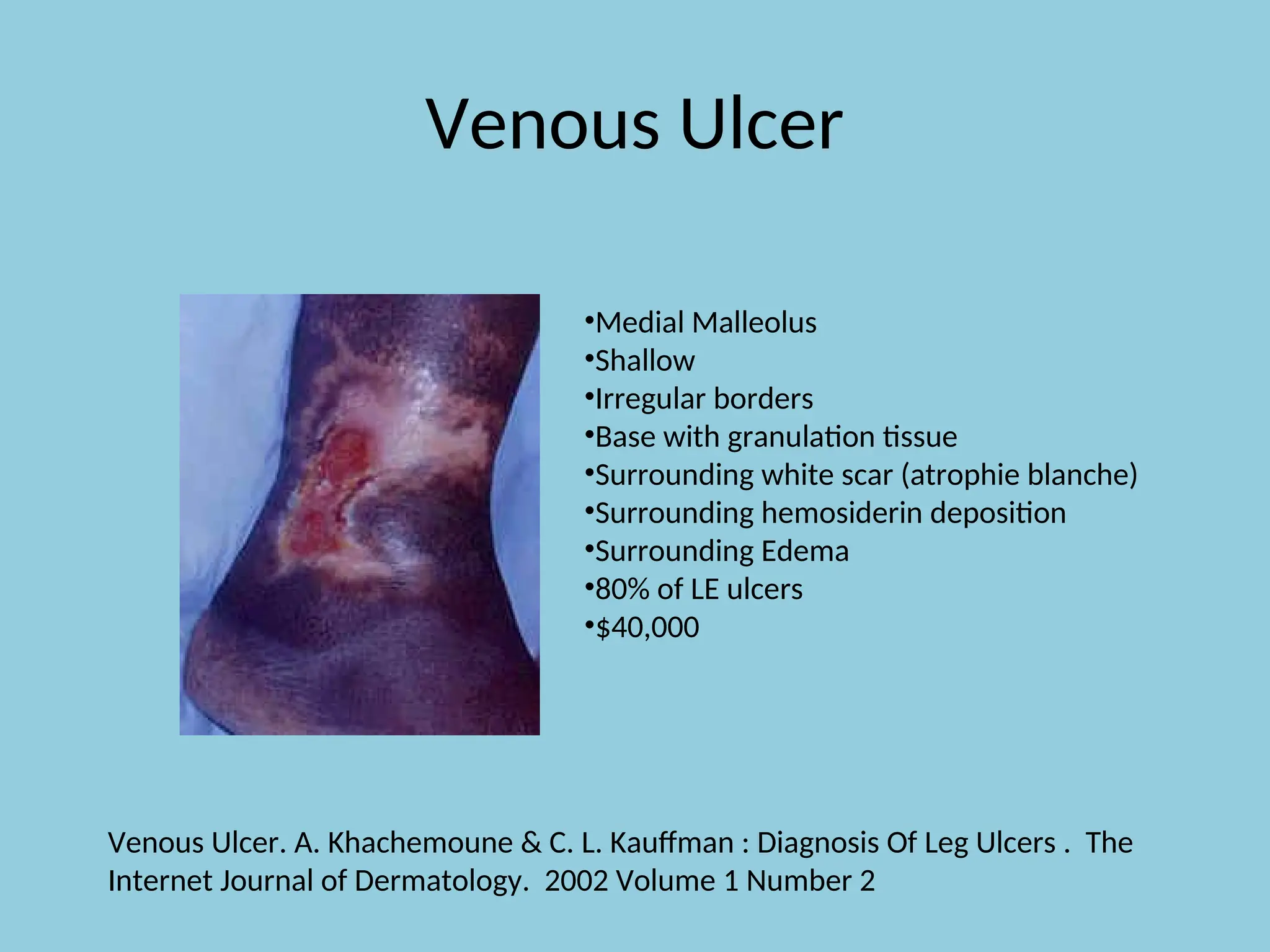 chronic venous insufficiency definition etiology | PPT