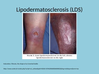 chronic venous insufficiency definition etiology | PPT
