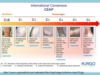chronic venous insufficiency definition etiology | PPT