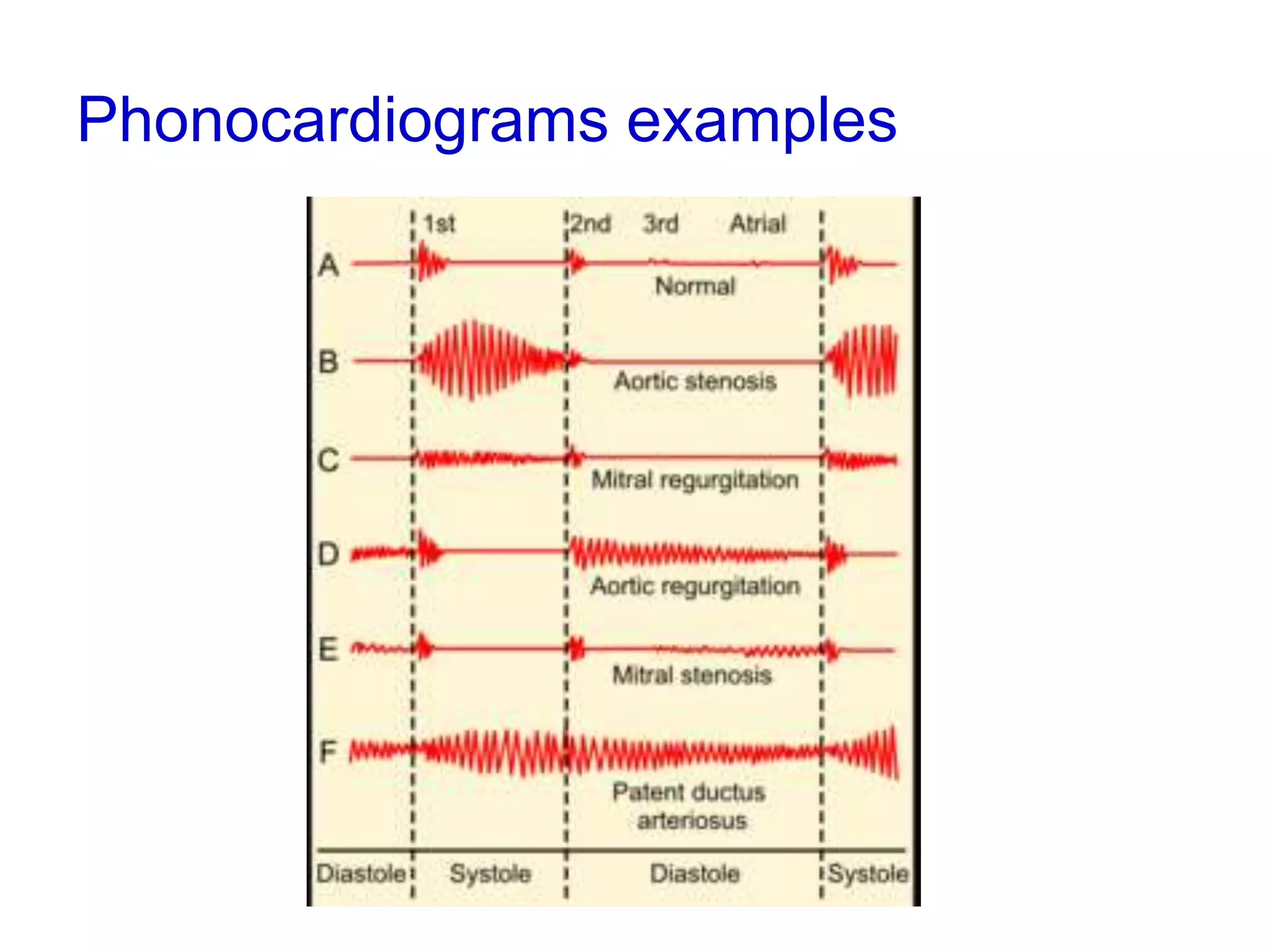 347_heart_sounds_&_murmurs.ppt