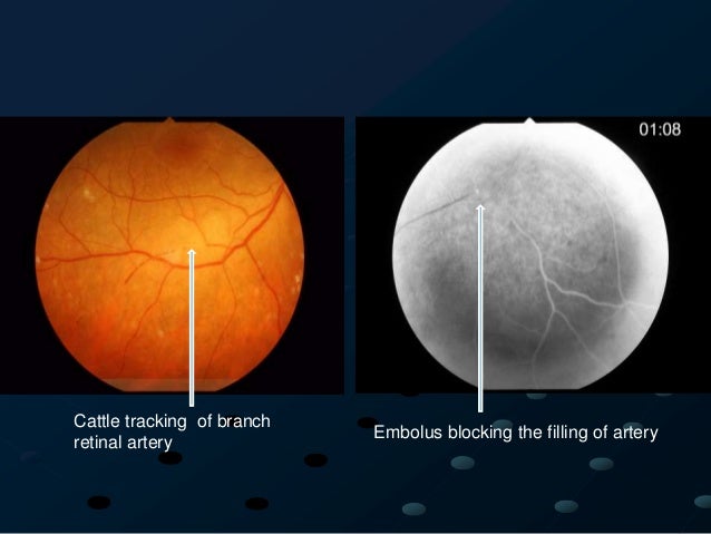 A Needle In Time, Saves Eye