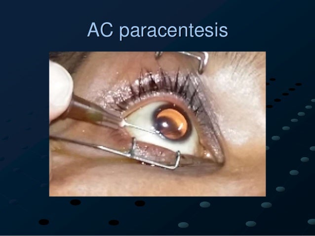 A Needle In Time, Saves Eye