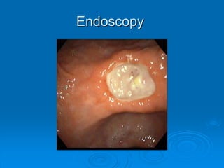 lecture note on Peptic ulcer pathophysiology .ppt