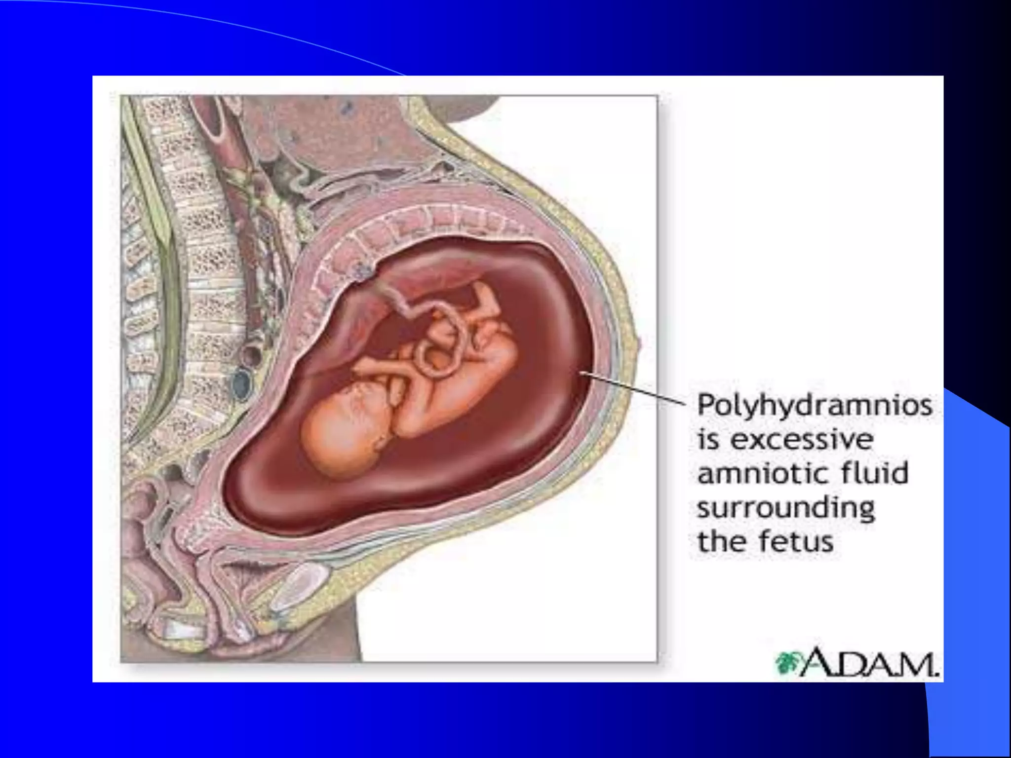 POLYHYDRAMNIOS AND OLIGOHYDRAMNIOS.ppt