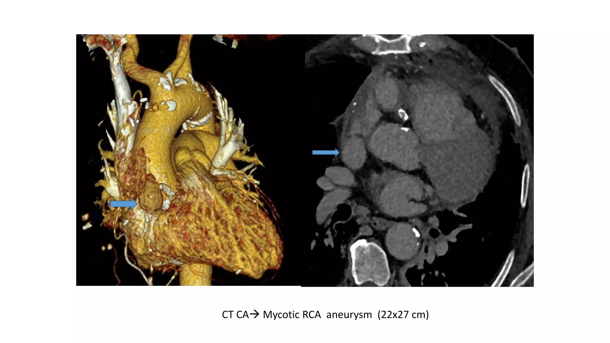 Giant Coronary Aneurysm - Hesham Abdelaziz | PPTX