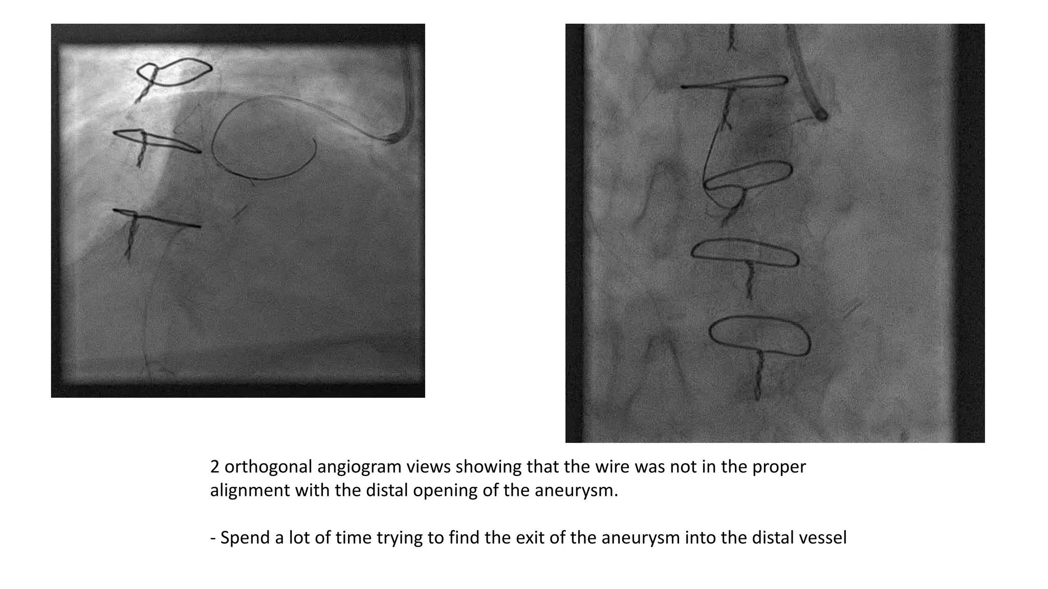 Giant Coronary Aneurysm - Hesham Abdelaziz | PPTX