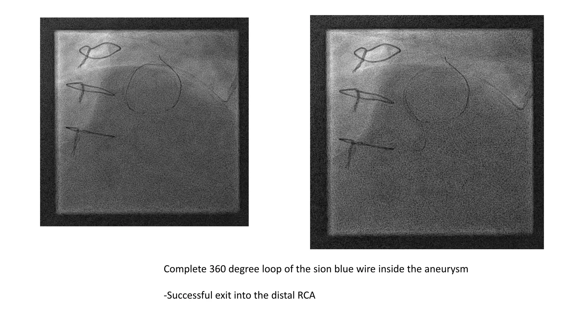 Giant Coronary Aneurysm - Hesham Abdelaziz | PPTX