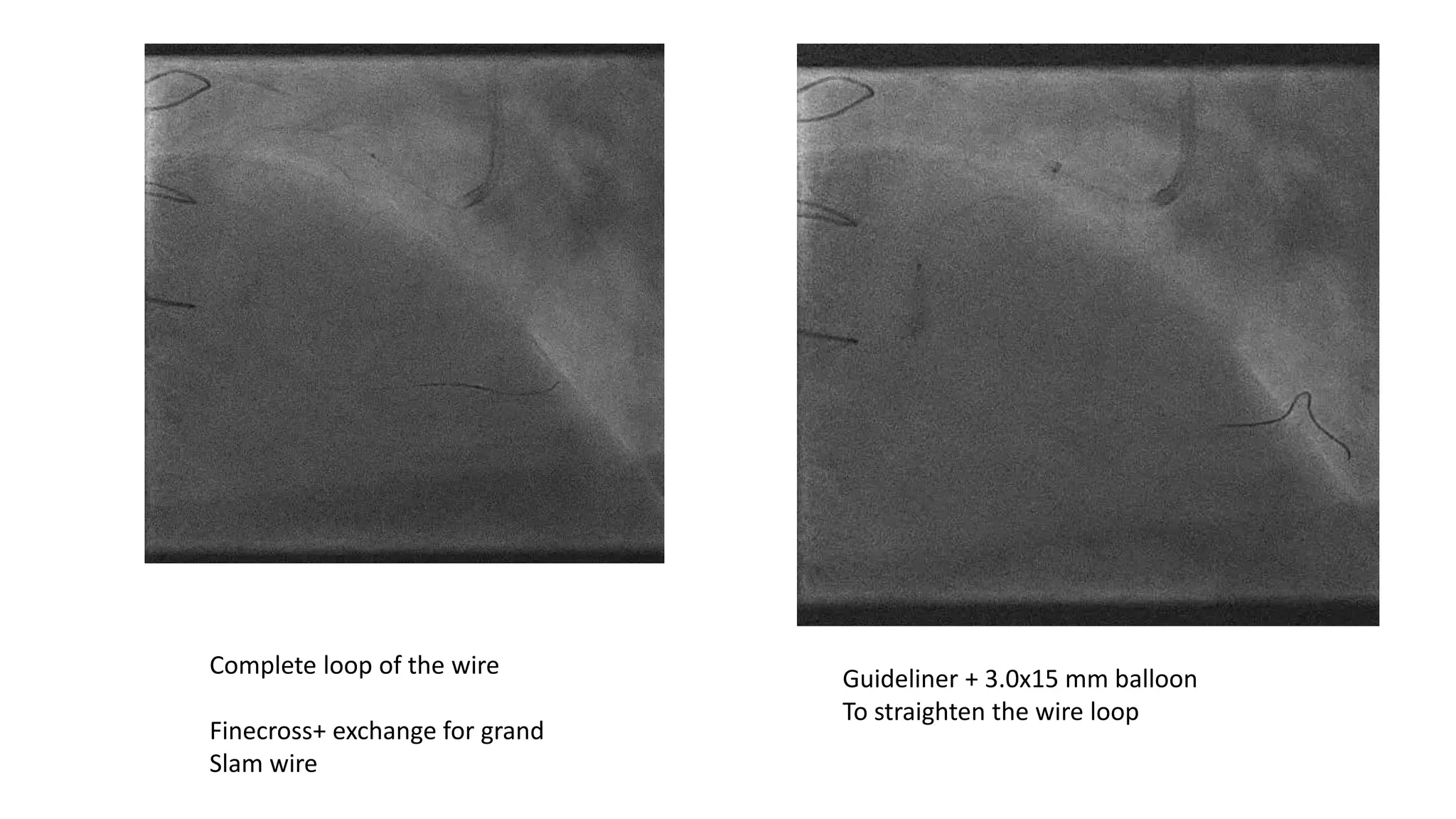 Giant Coronary Aneurysm - Hesham Abdelaziz | PPTX