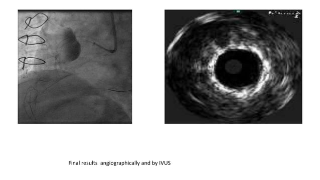 Giant Coronary Aneurysm - Hesham Abdelaziz | PPTX | Heart and Cardiovascular Diseases | Diseases ...
