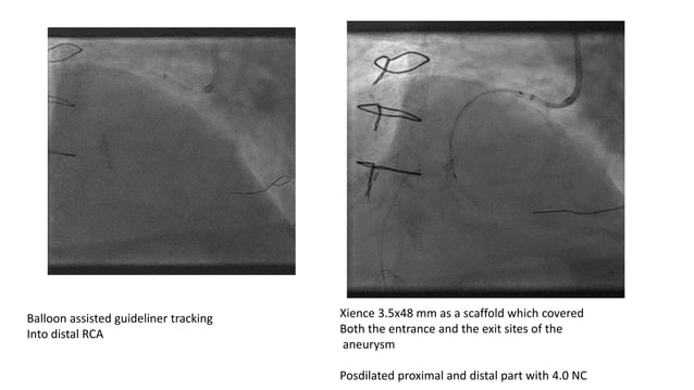 Giant Coronary Aneurysm - Hesham Abdelaziz | PPTX | Heart and Cardiovascular Diseases | Diseases ...