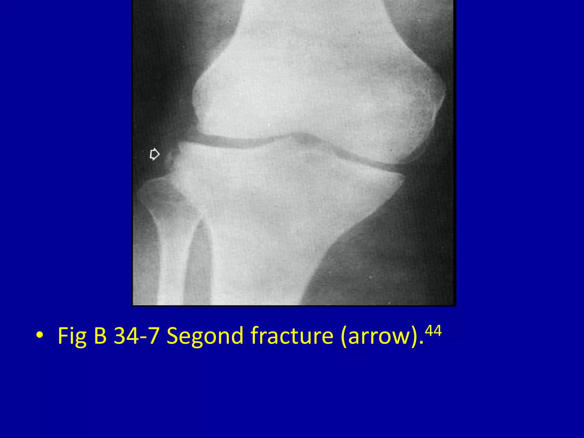 34 avulsion injuries | PPTX