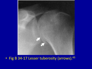 34 avulsion injuries | PPTX