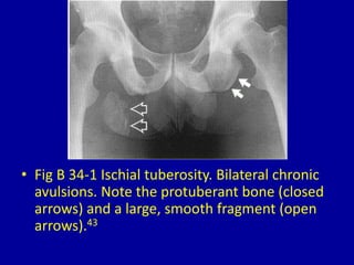 34 avulsion injuries | PPTX