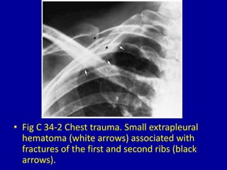 34 extrapleural lesion | PPT