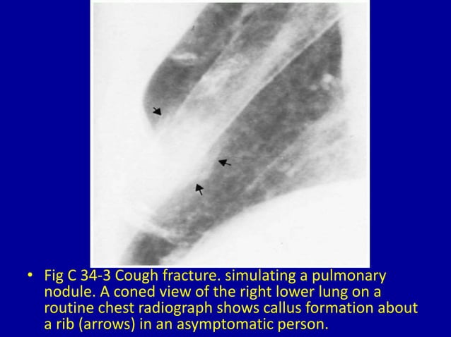 34 extrapleural lesion | PPT