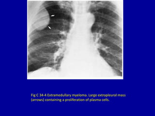 34 extrapleural lesion | PPT