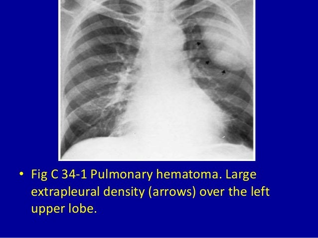 34 extrapleural lesion