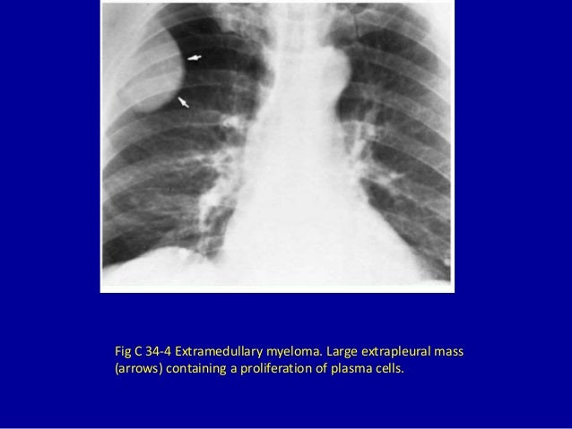 34 extrapleural lesion