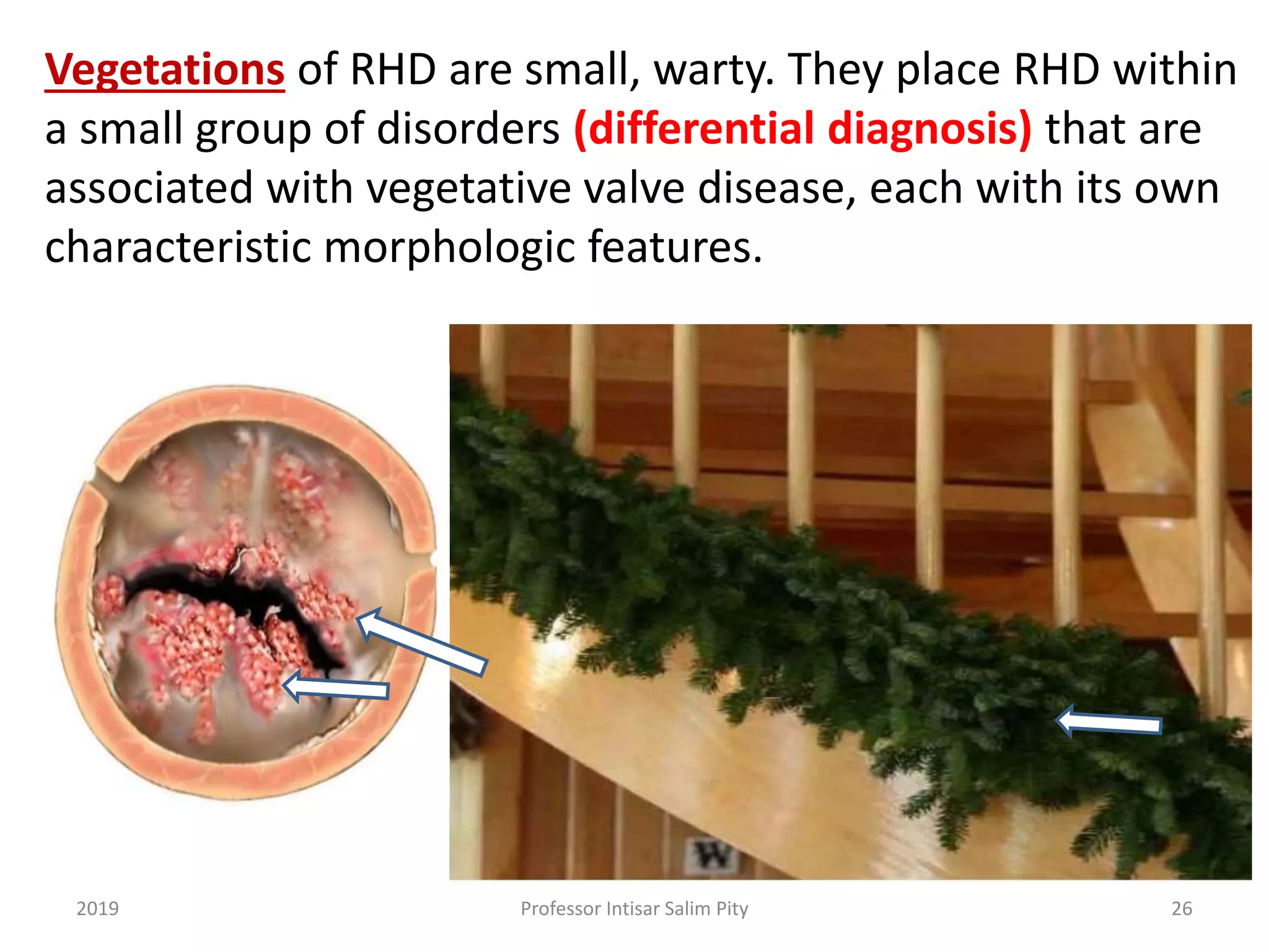 Rheumatic fever, RHD, and infective endocarditis | PPTX