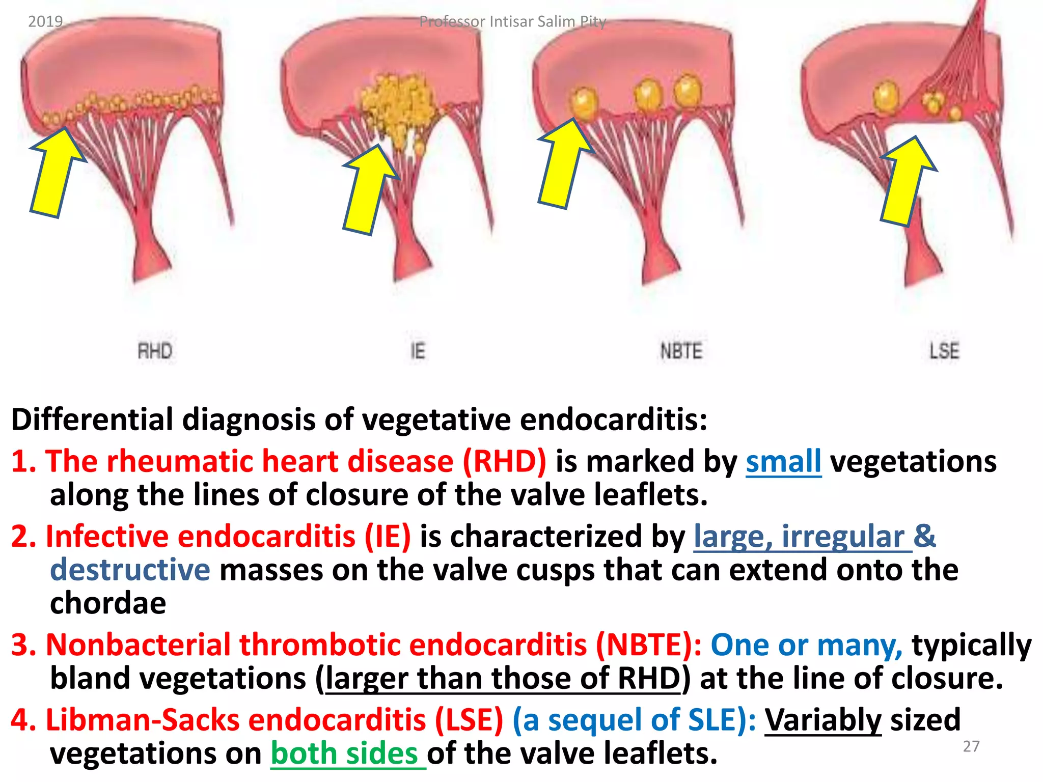 Rheumatic fever, RHD, and infective endocarditis | PPTX
