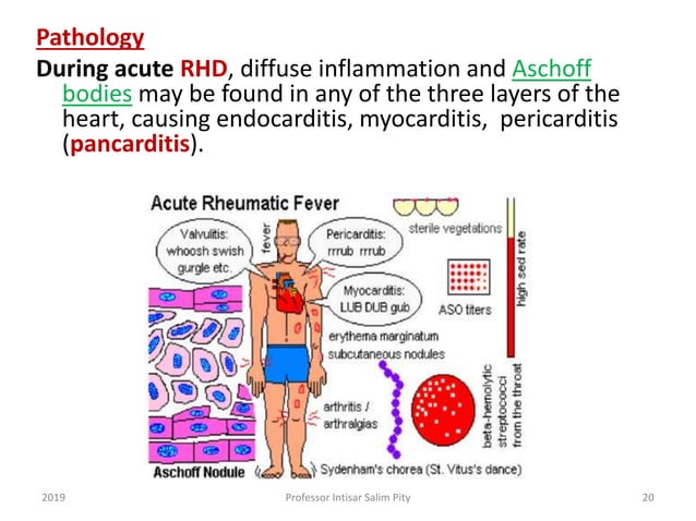 Rheumatic fever, RHD, and infective endocarditis | PPTX