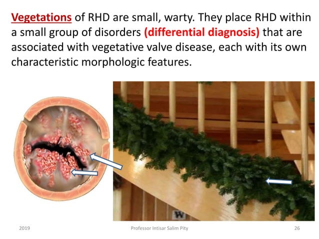 Rheumatic fever, RHD, and infective endocarditis | PPTX